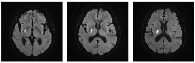 Simple brain MRI in axial view, DWI sequence